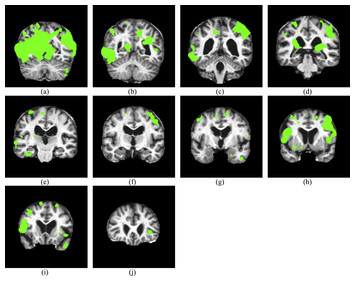 Detection of Alzheimer’s disease by displacement field and machine ...